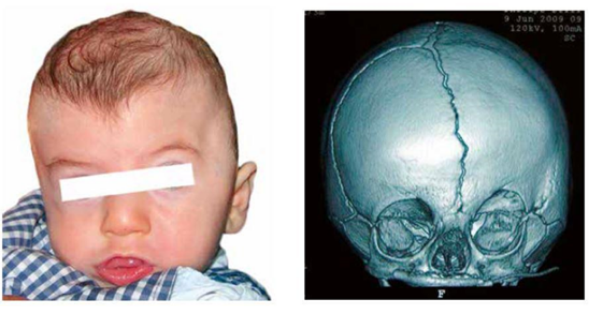 Tipos de deformidades craneales