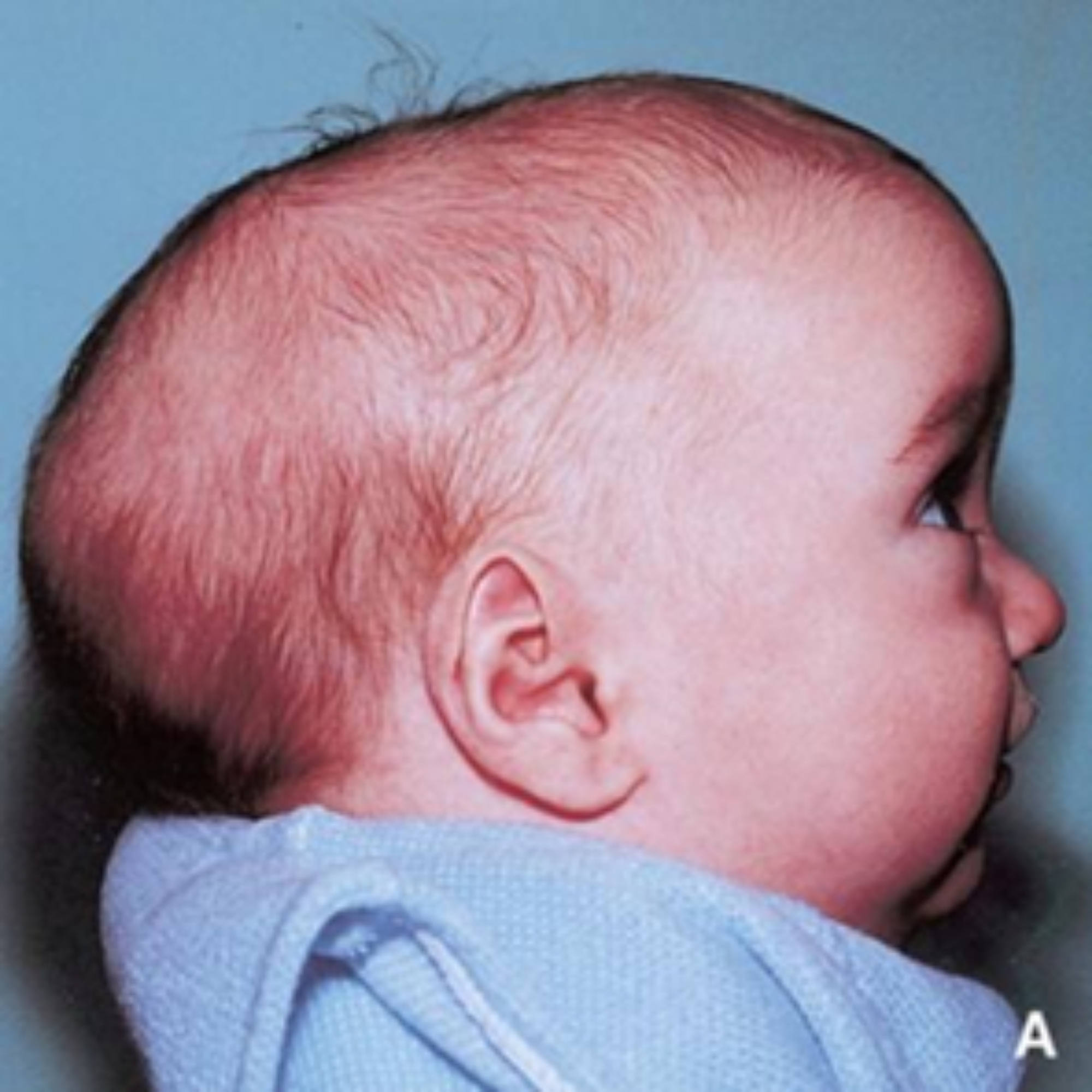 Tipos de deformidades craneales