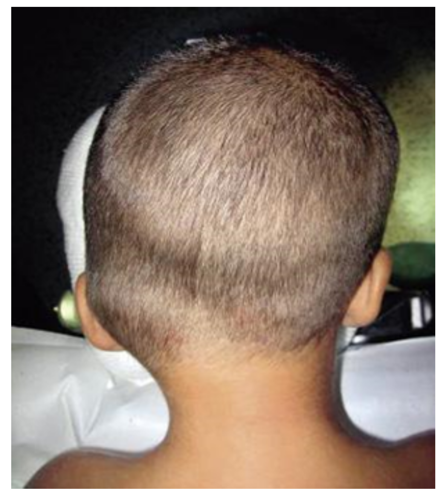 Tipos de deformidades craneales